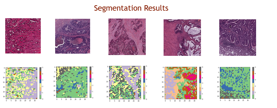 Optimization of the optics lens in Classification of Colorectal Cancer ...